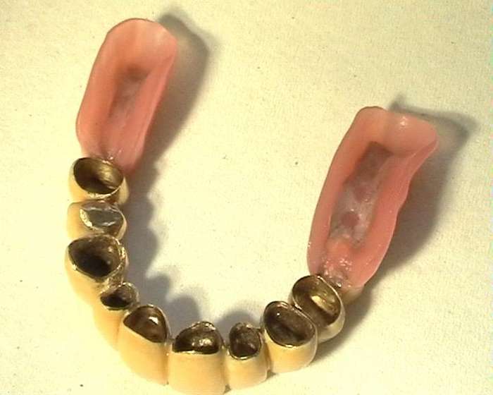 Zahnarzt Marburg - Dr. Jochum | kombinierter Zahnersatz - Prothese mit ...